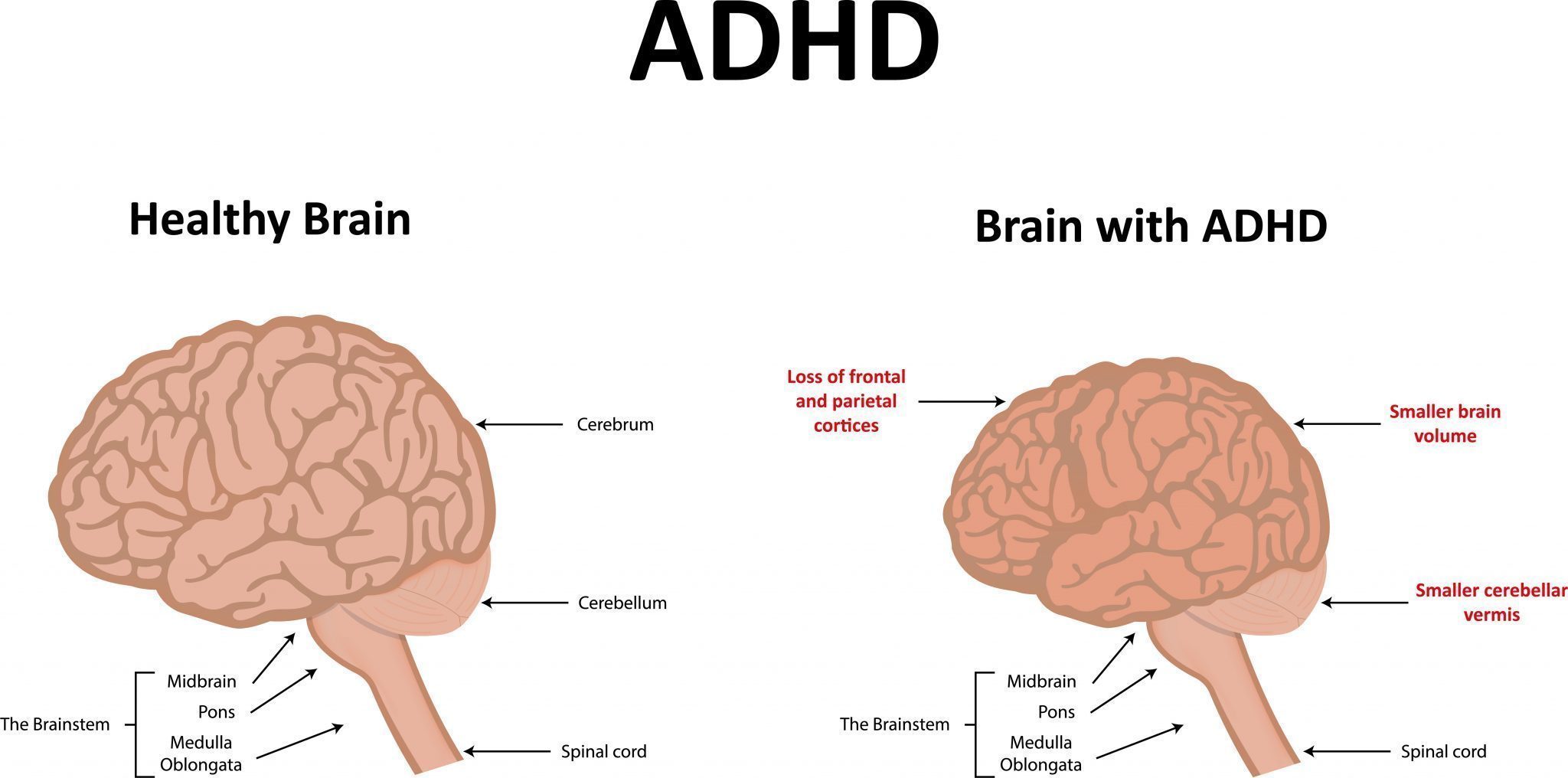 What Causes ADHD: Comparing Facts and Myths - Health, Brain and ...